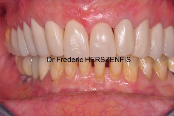 Restaurations dentaires rapides (provisoires puis définitives) : quel ...