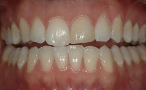 Facette dentaire sur une dent de devant jaunie : photos avant et après ...