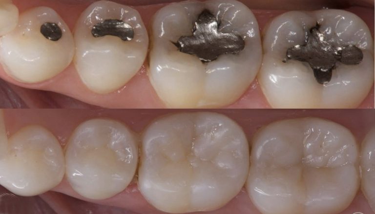 Qui utilise encore des plombages ? Parlons plutôt des Inlays/Onlays ...